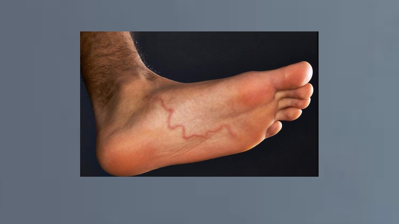 Most Effective Treatment For Hookworm Infections in Humans - Genius Blogger